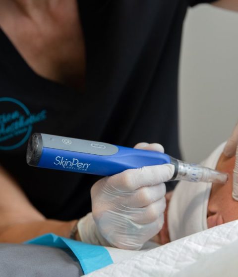 Skin Needling - Precision Aesthetics
